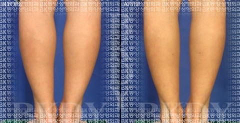 BK Plastic Surgery: BK Plastic Surgery Hospital's Calf Reduction Surgery